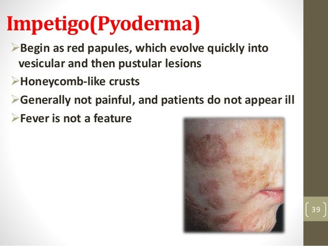 Streptococcal infections