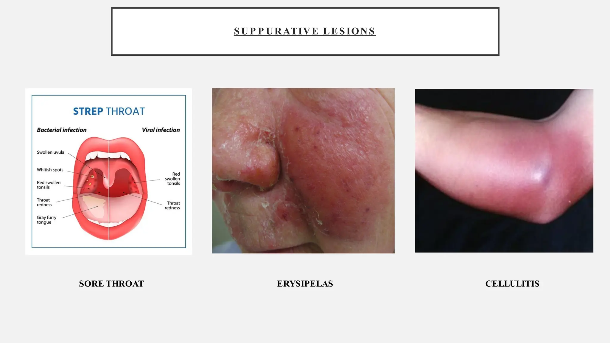 Streptococcal Infectionspdf Jeufjdhwjsn Ppt