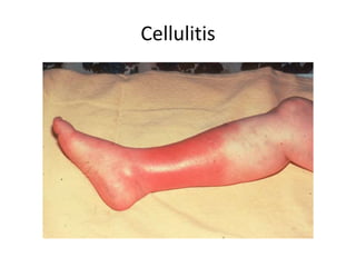 Streptococcus | PPTX