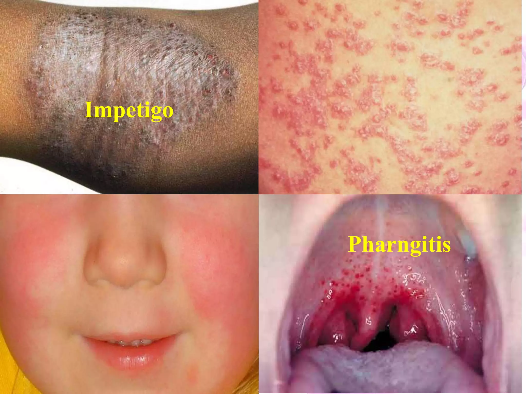 Streptococcus | PPSX | Ear, Nose and Throat Conditions | Diseases and ...