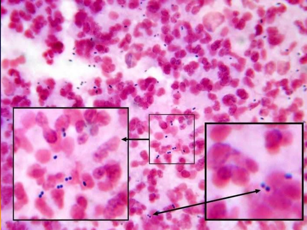 Streptococcus pneumoniae