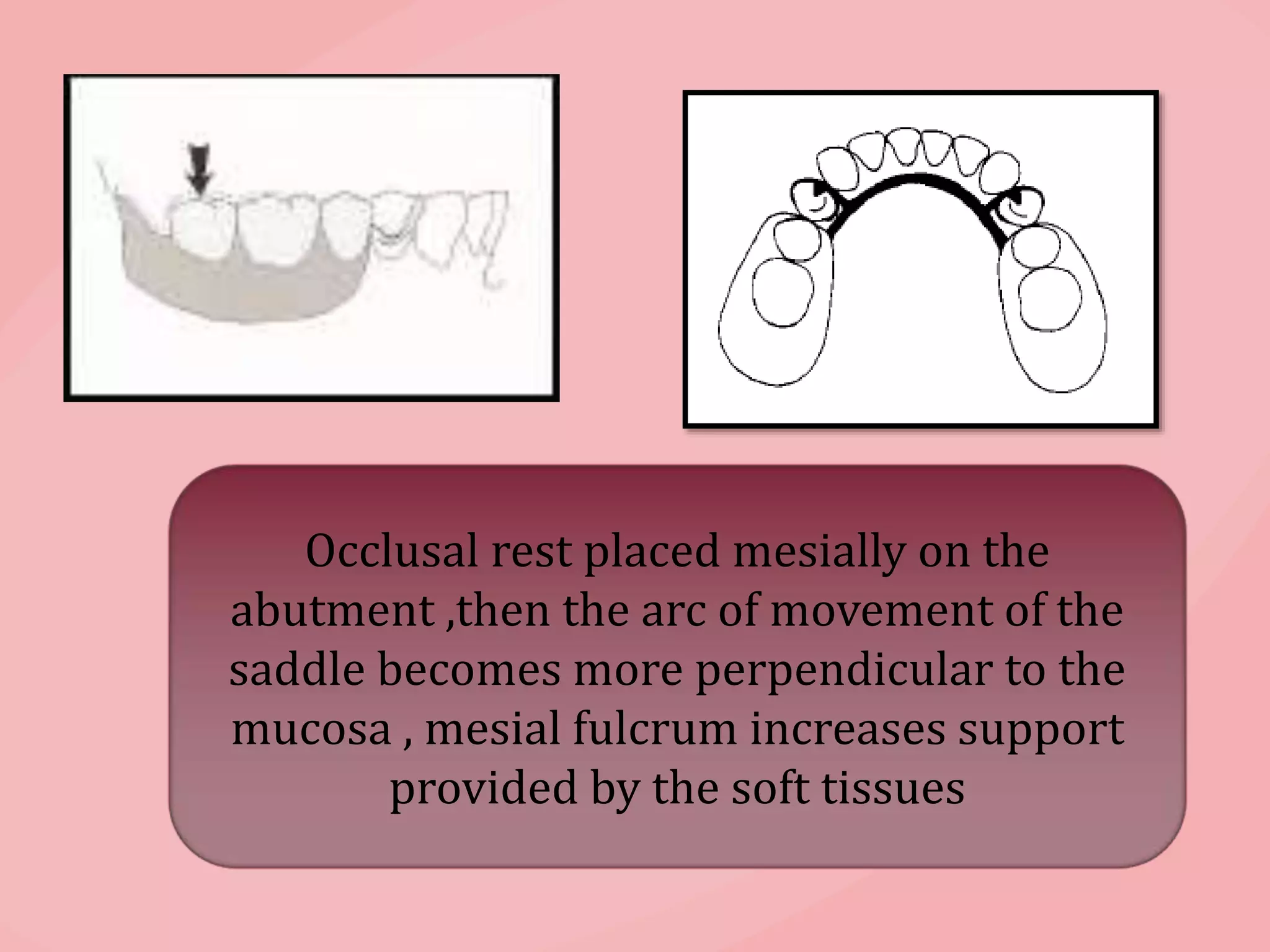 Stress breaker in rpd | PPT