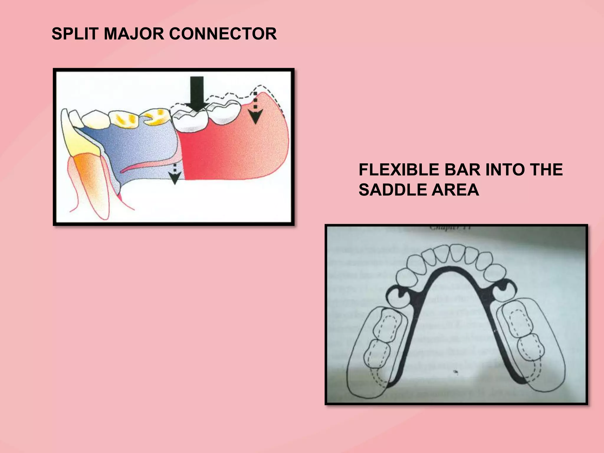 Stress breaker in rpd | PPT