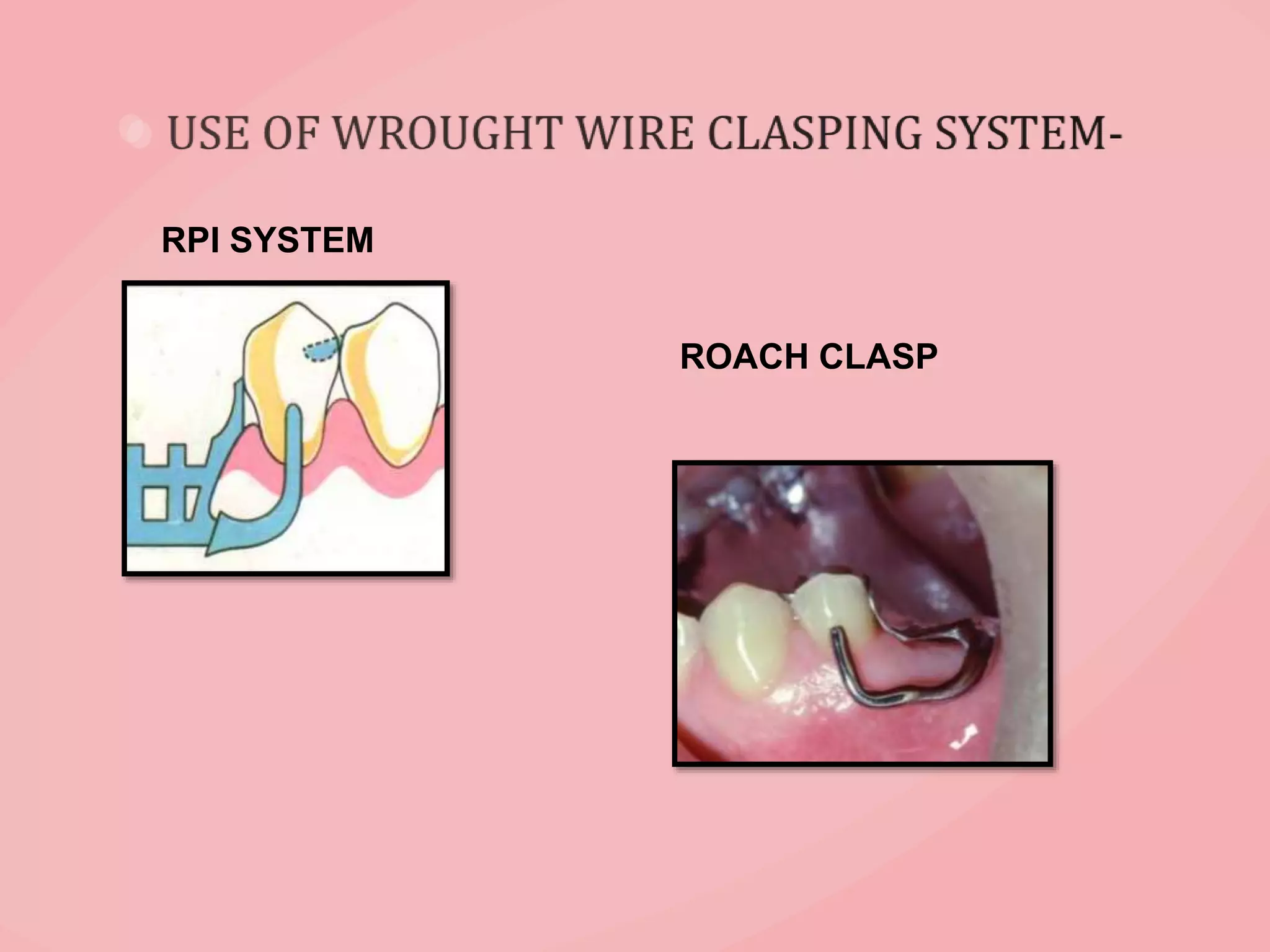 Stress breaker in rpd | PPT