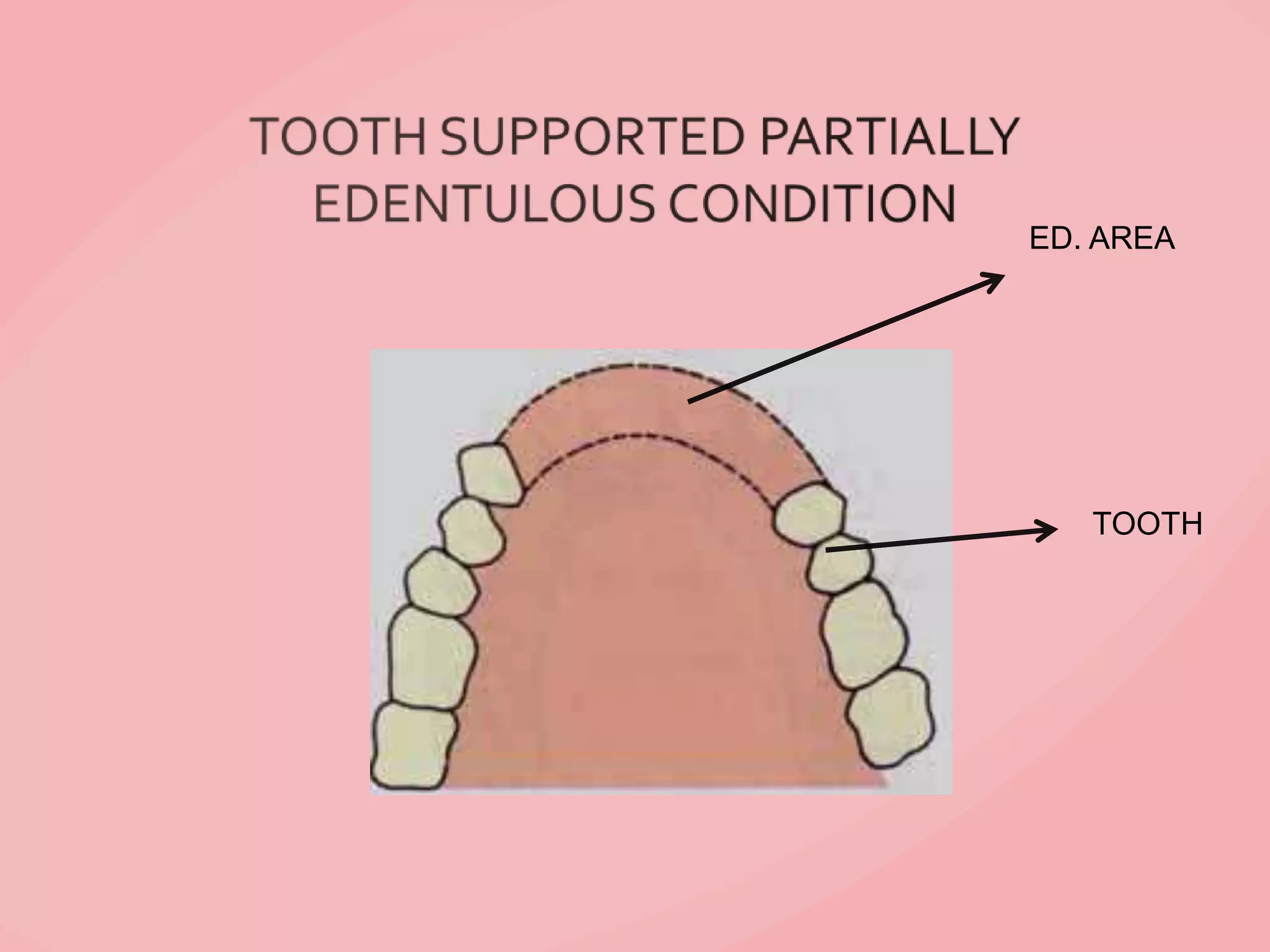 Stress breaker in rpd | PPT