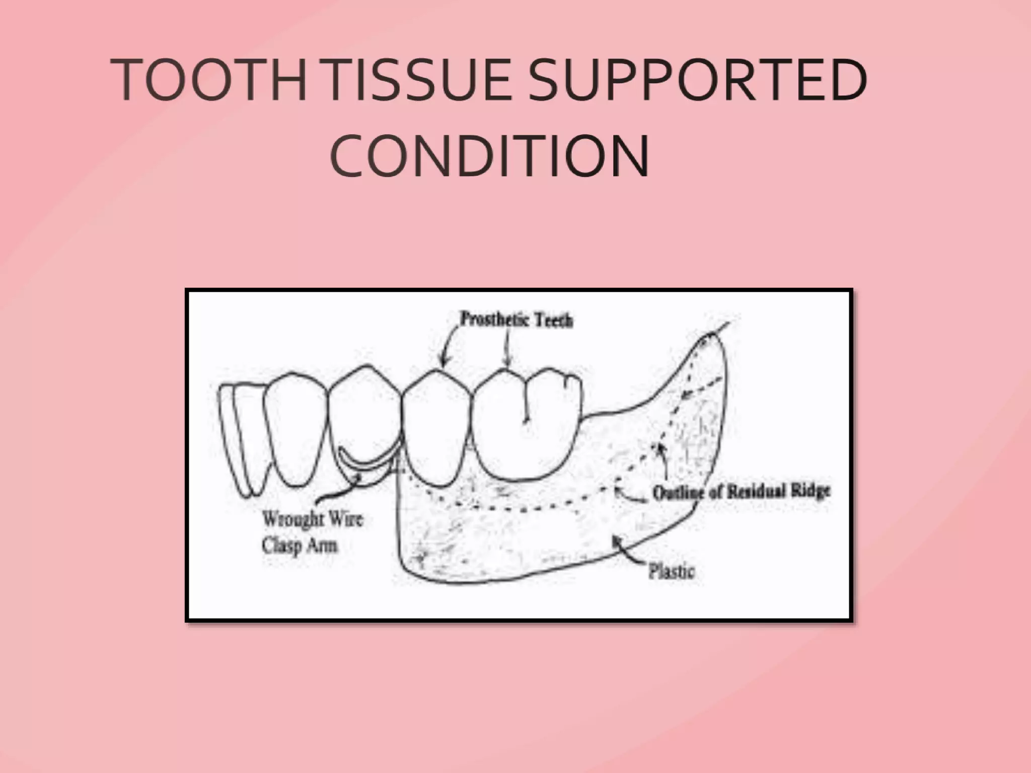 Stress breaker in rpd | PPT