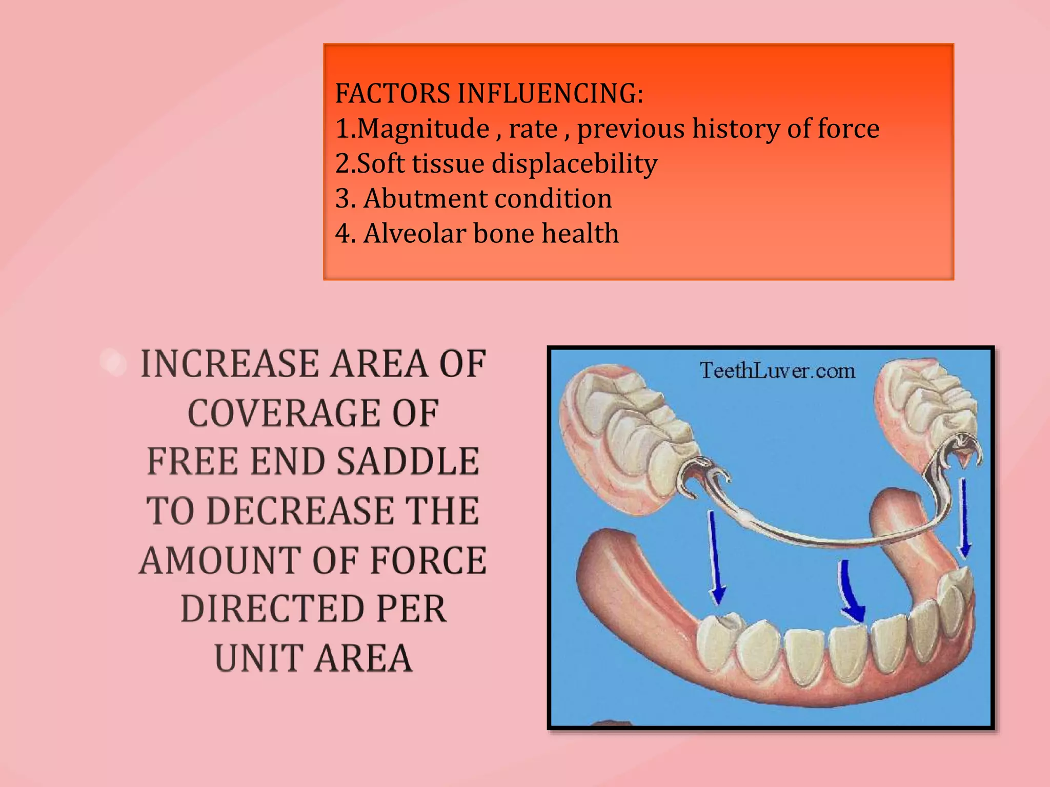 Stress breaker in rpd | PPT