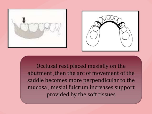 Stress breaker in rpd | PPT | Dental Health | Diseases and Conditions