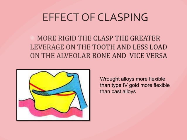 Stress breaker in rpd | PPT | Dental Health | Diseases and Conditions