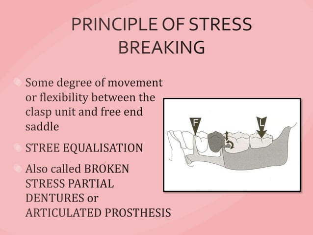 Stress breaker in rpd | PPT | Dental Health | Diseases and Conditions