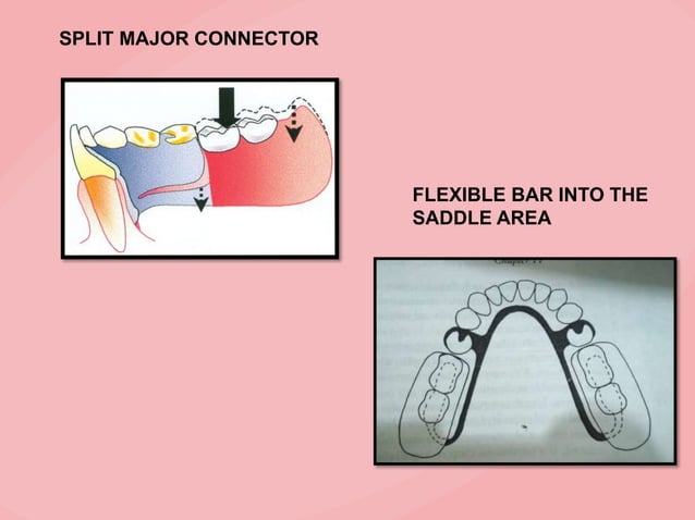 Stress breaker in rpd | PPT | Dental Health | Diseases and Conditions