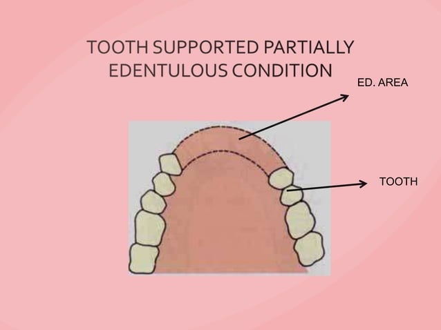 Stress breaker in rpd | PPT | Dental Health | Diseases and Conditions