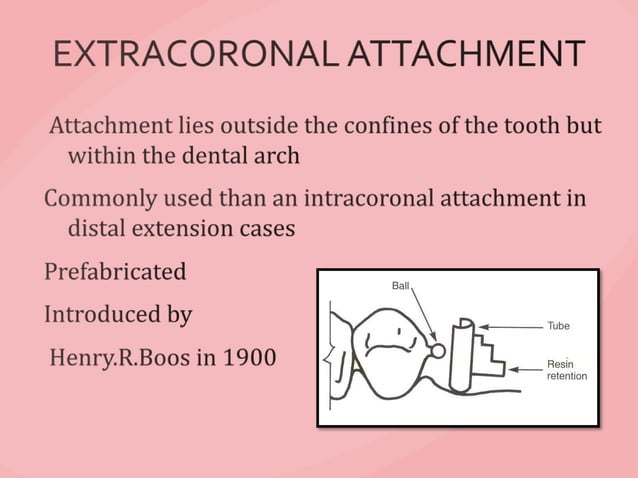 Stress breaker in rpd | PPT | Dental Health | Diseases and Conditions
