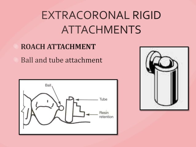 Stress breaker in rpd | PPT | Dental Health | Diseases and Conditions