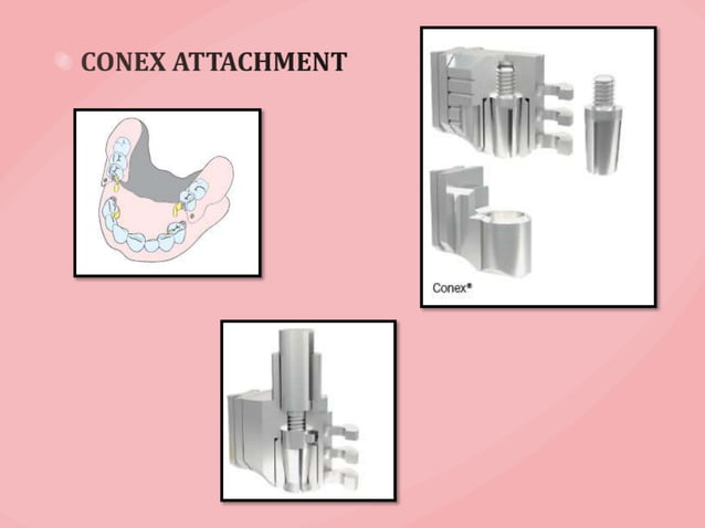 Stress breaker in rpd | PPT | Dental Health | Diseases and Conditions