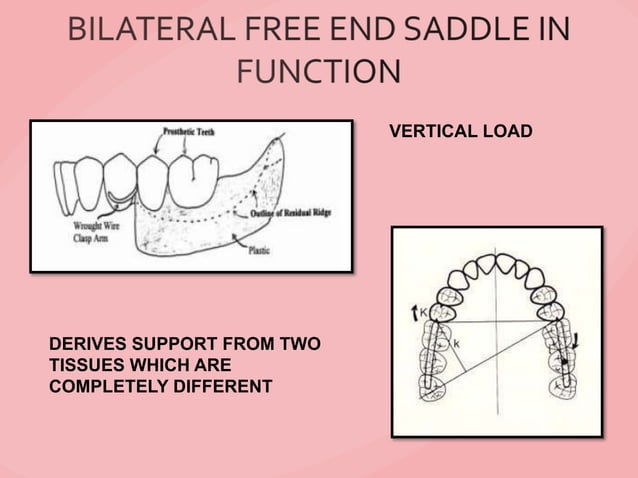 Stress breaker in rpd | PPT | Dental Health | Diseases and Conditions