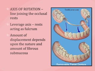 Stress breaker in rpd | PPT