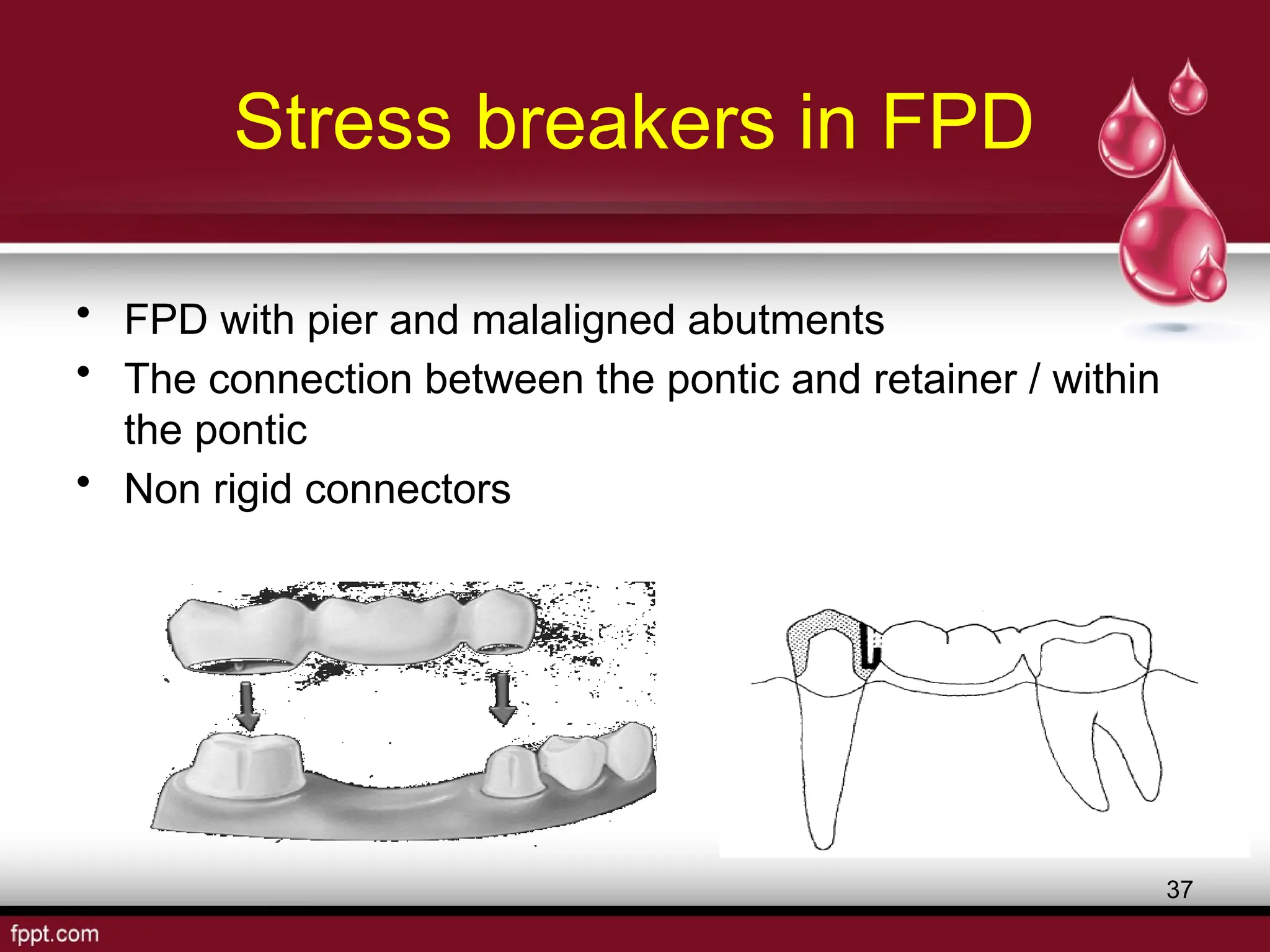 STRESS BREAKERS IN PROSTHODONTIC DENTISTRY | PPTX
