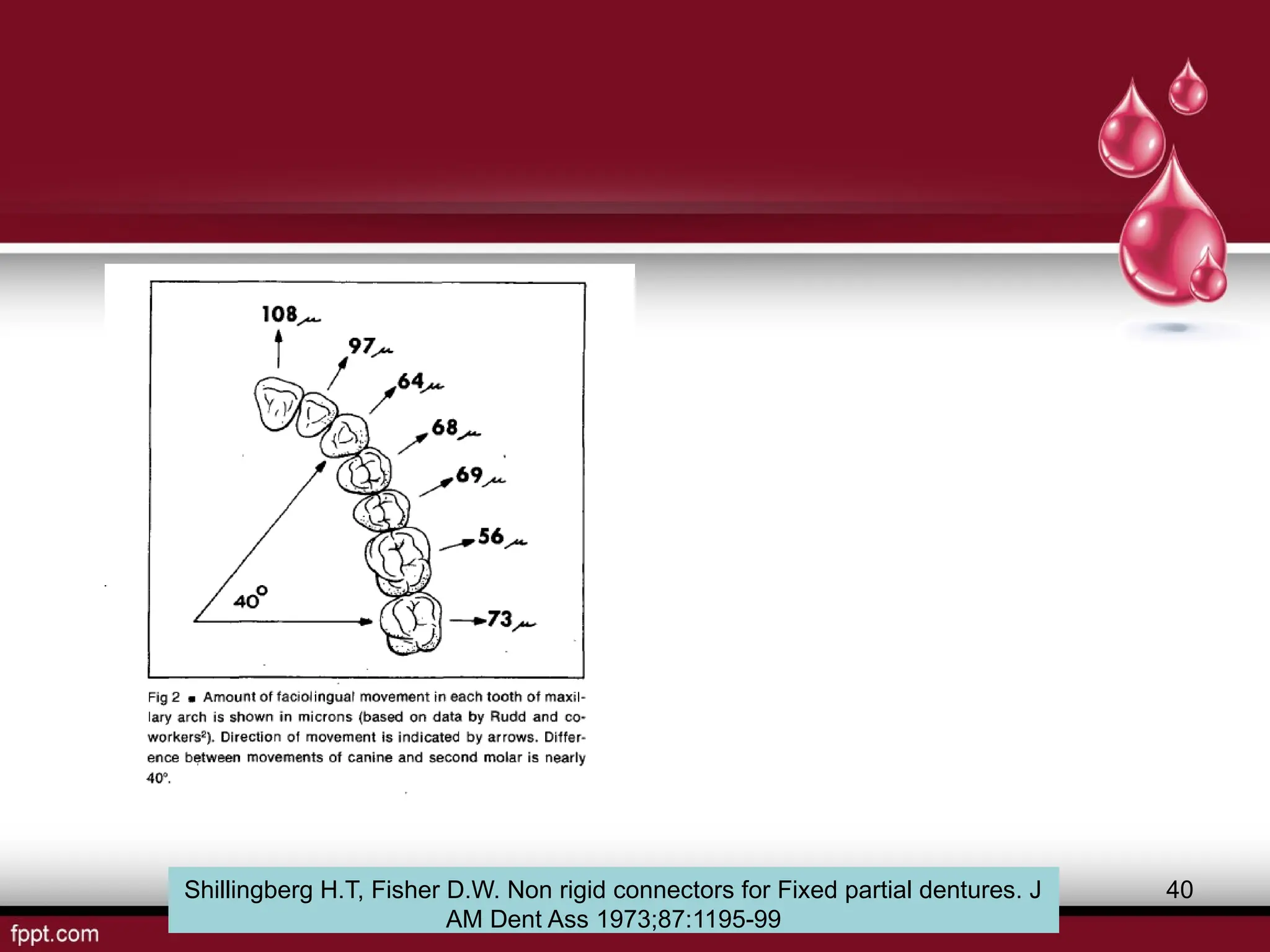 STRESS BREAKERS IN PROSTHODONTIC DENTISTRY | PPTX