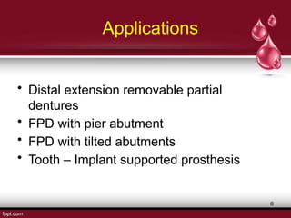 STRESS BREAKERS IN PROSTHODONTIC DENTISTRY | PPTX