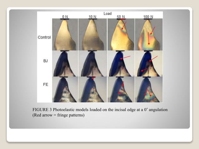 Stress distribution within the ceramic veneer-tooth system with butt ...