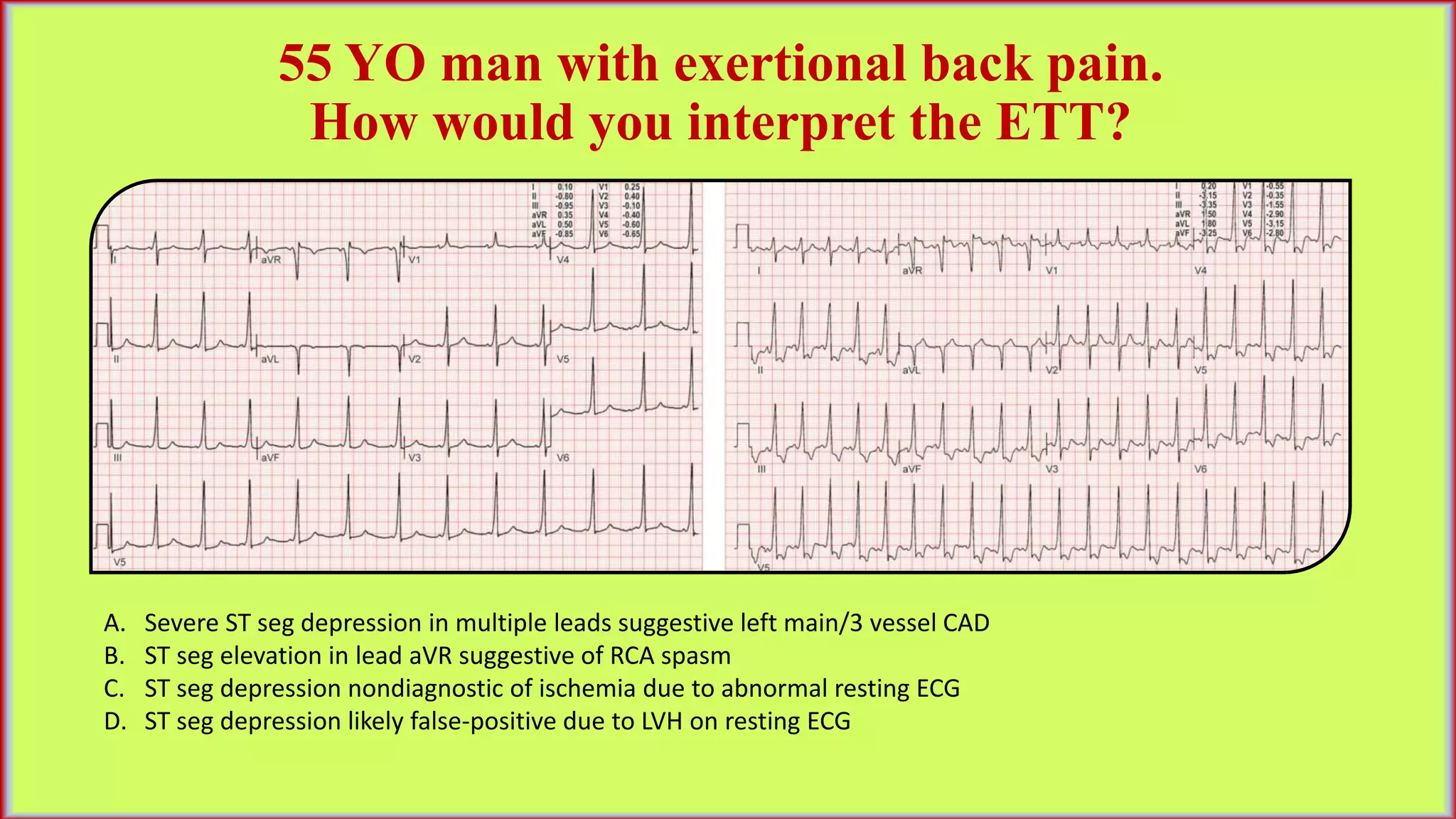 Exercise ECG Testing | PPTX
