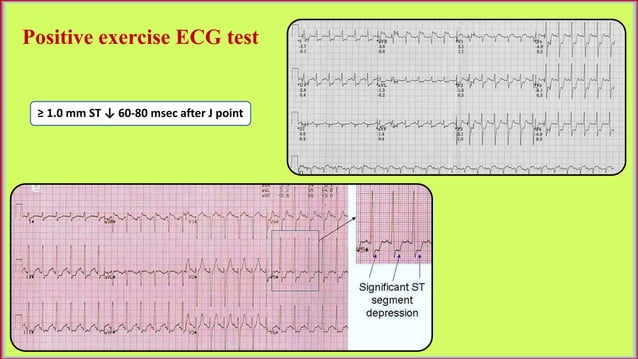 Exercise ECG Testing | PPTX | Heart and Cardiovascular Diseases ...