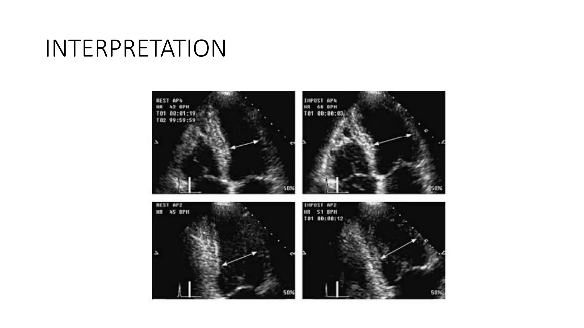 STRESS ECHOCARDIOGRAPHY.pptx | Physical Therapy | Wellness