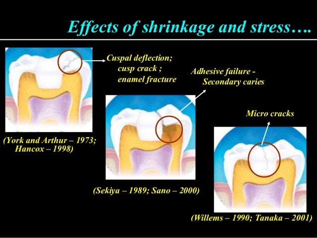 Stresses in adhesive restorations / dental courses