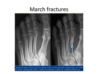Stress fracture: Causes, Investigation, Diagnosis, Treatment | PPTX