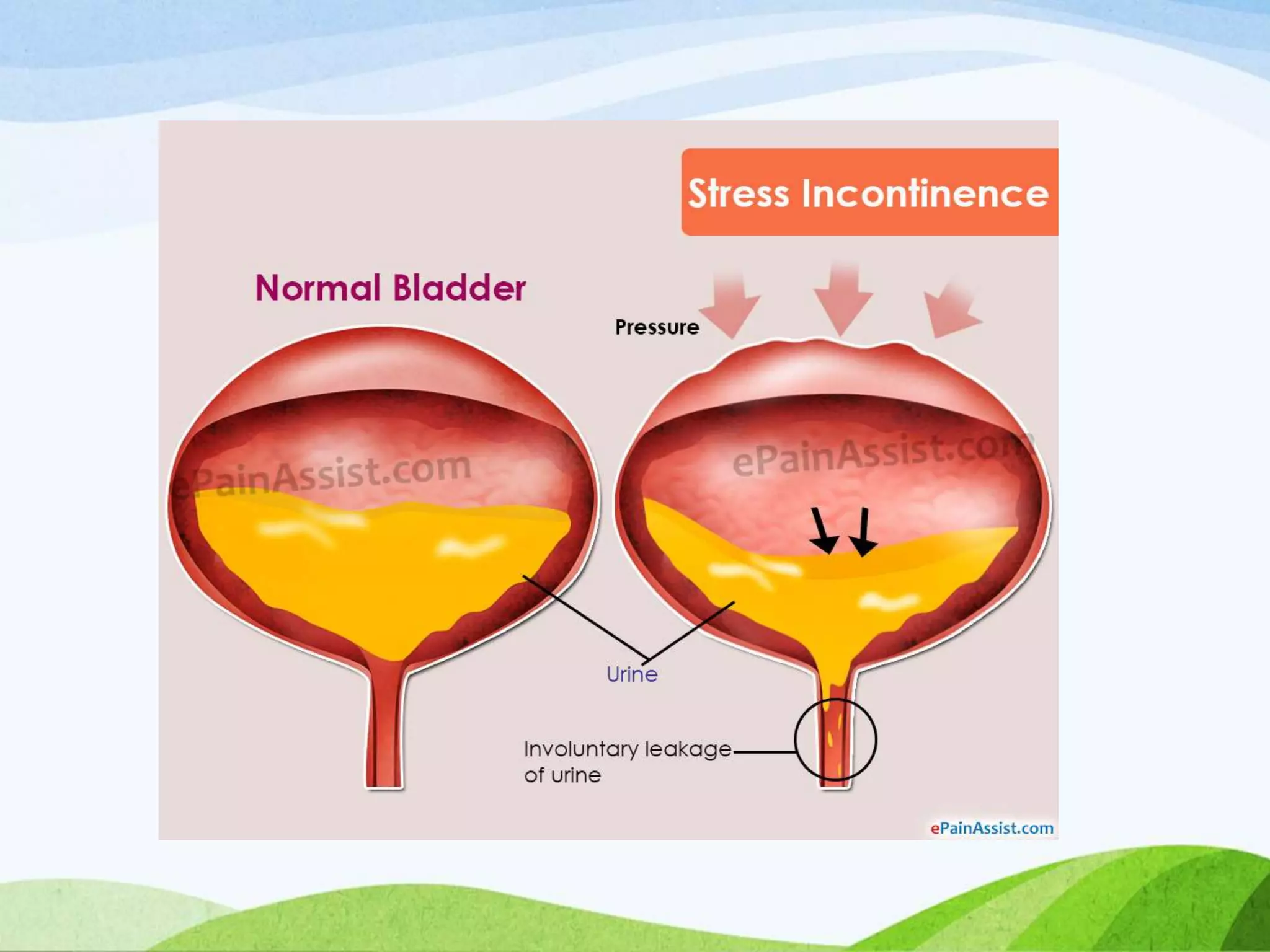 Urinary Stress Incontinence | PPTX