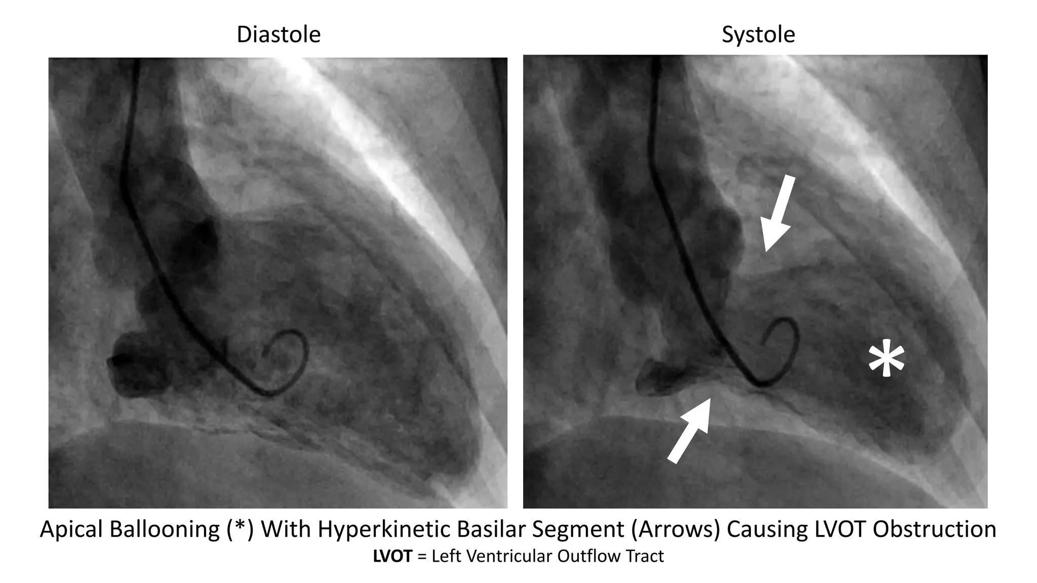 EMGuideWire's Radiology Reading Room: Stress-Induced Cardiomyopathy | PPTX