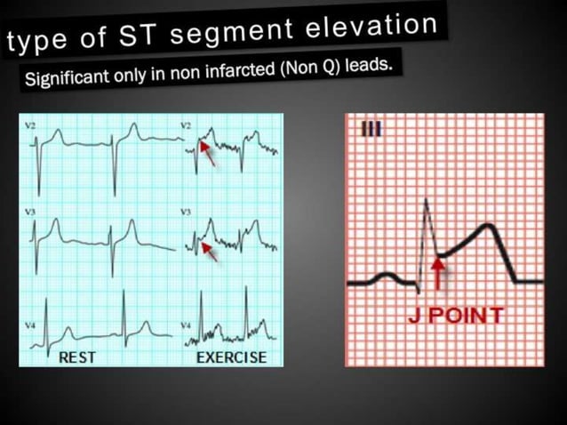 Interpretation of Stress test | PPT
