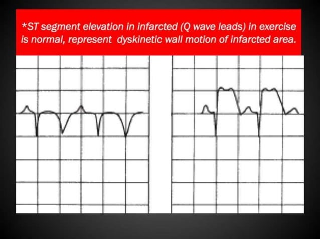 Interpretation of Stress test | PPT