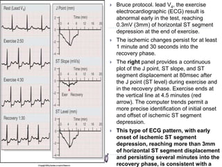 Abnormal Stress Test