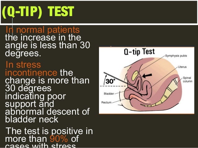 Stress urinary incontinance