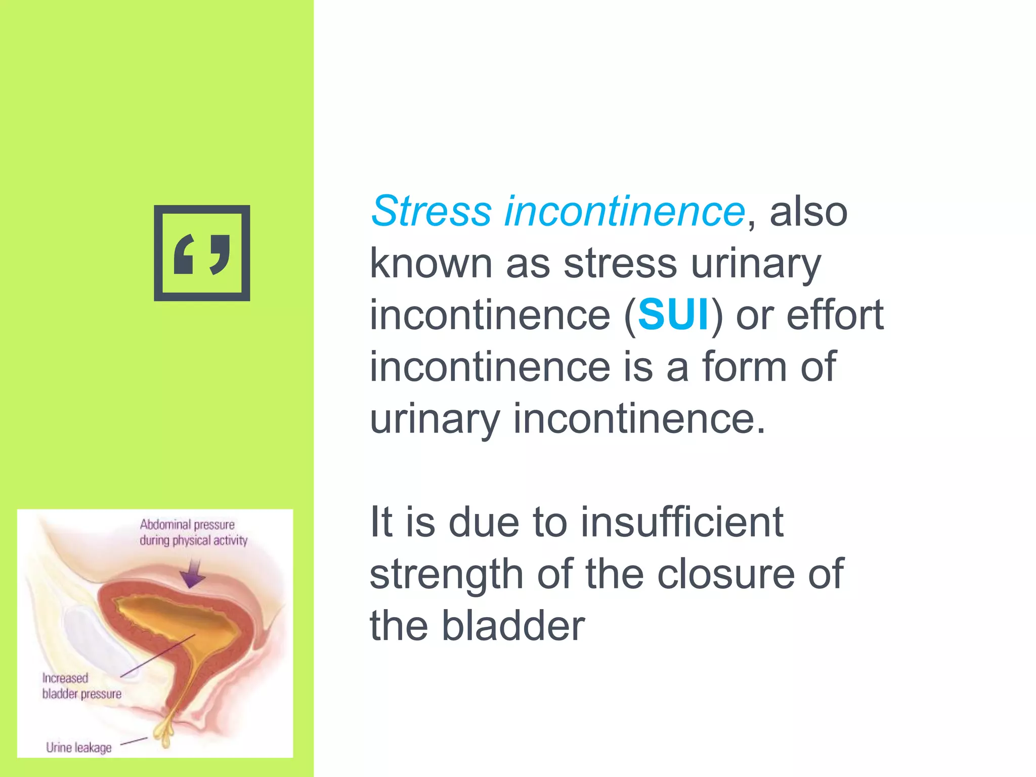 Stress urinary incontinence | PDF