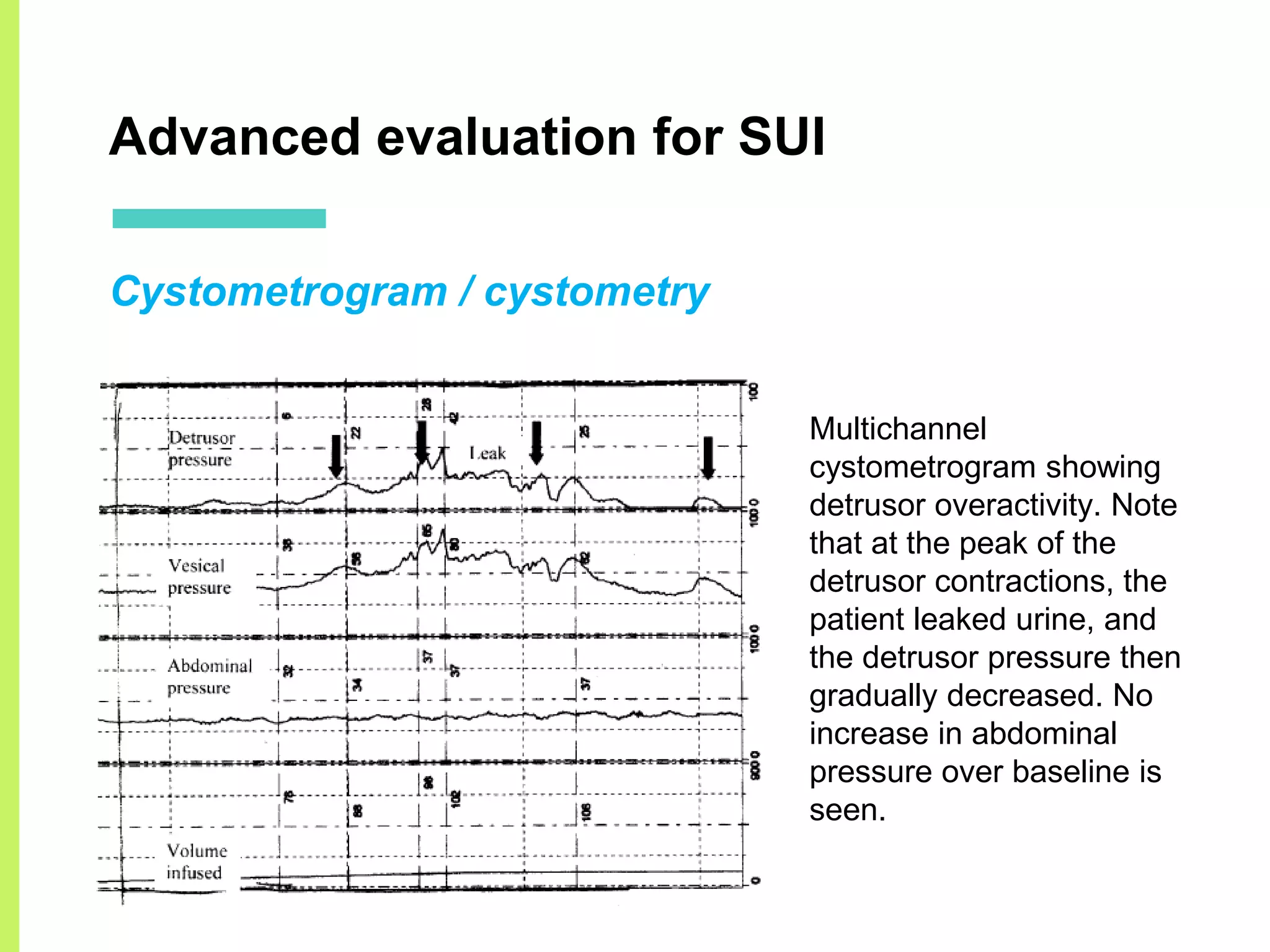 Stress urinary incontinence | PDF
