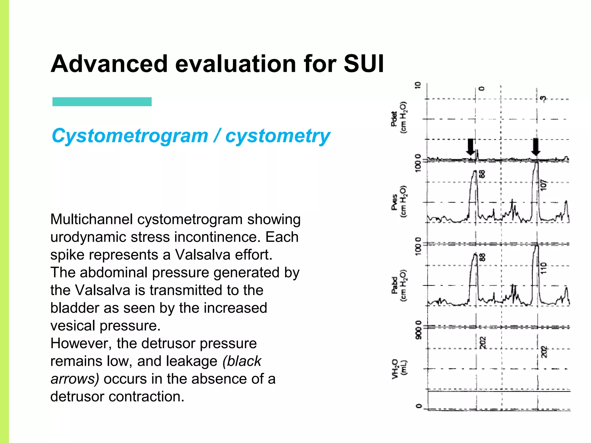 Stress urinary incontinence | PDF