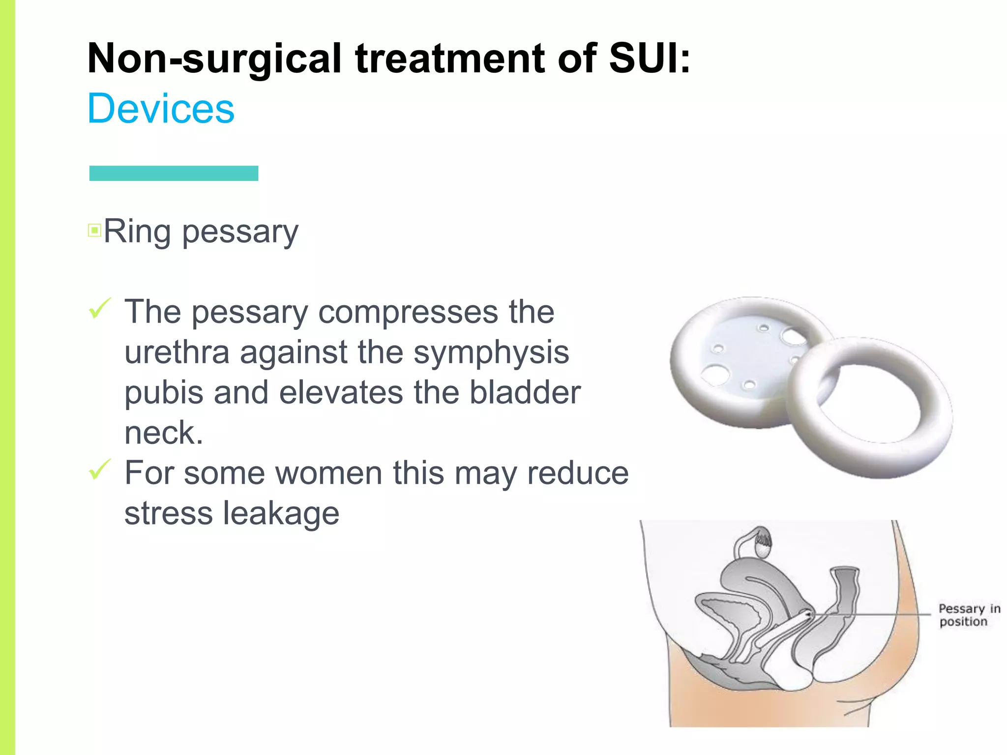 Stress urinary incontinence | PDF