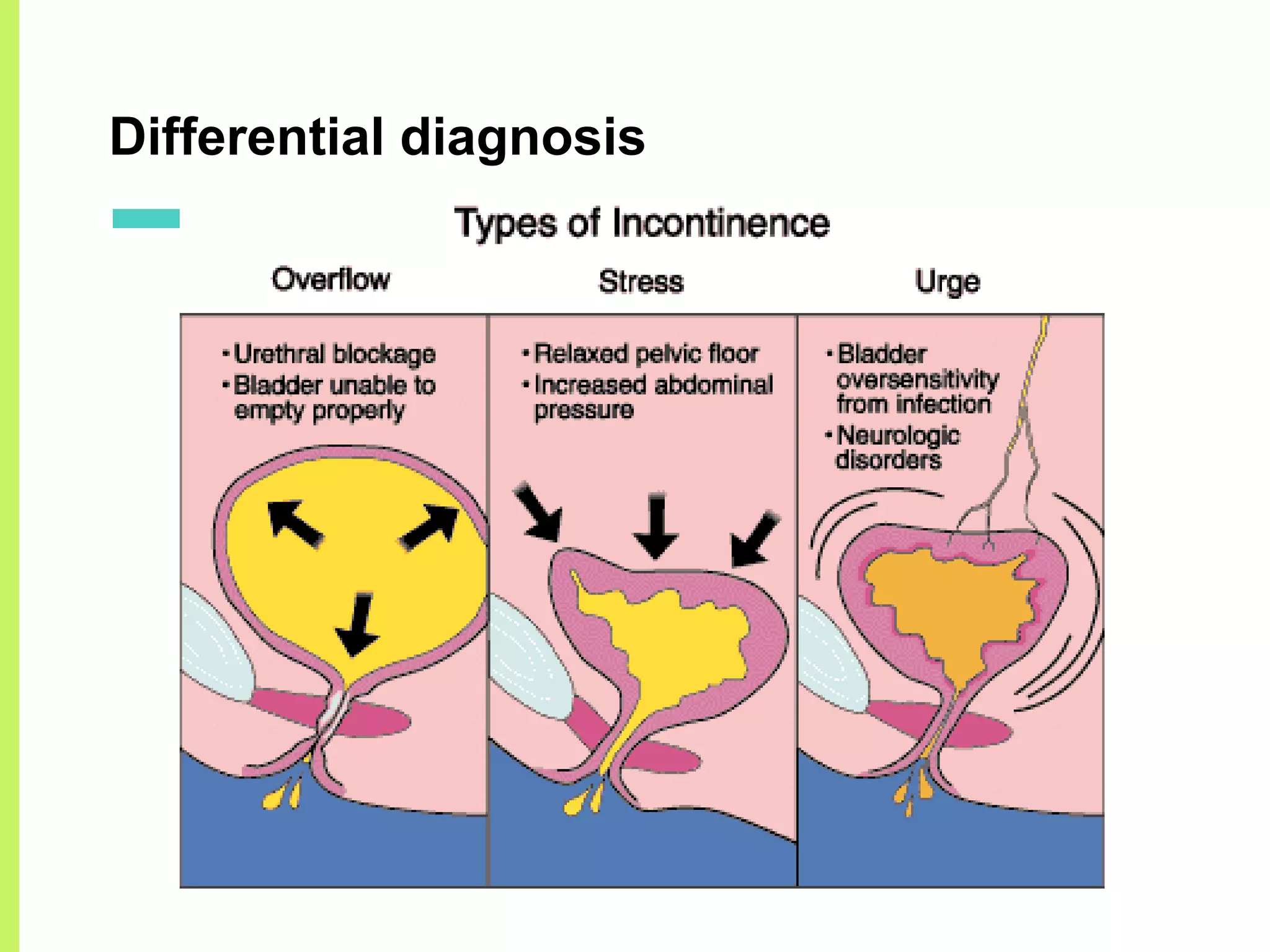 Stress urinary incontinence | PDF
