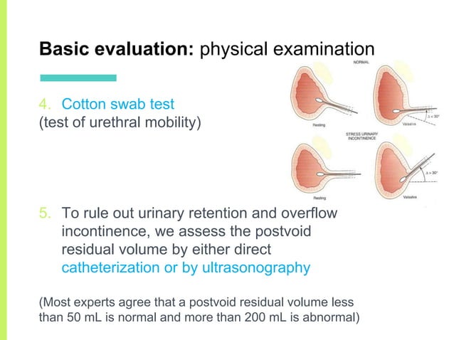 Stress urinary incontinence | PPT | Free Download