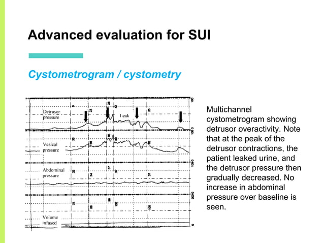 Stress urinary incontinence | PDF