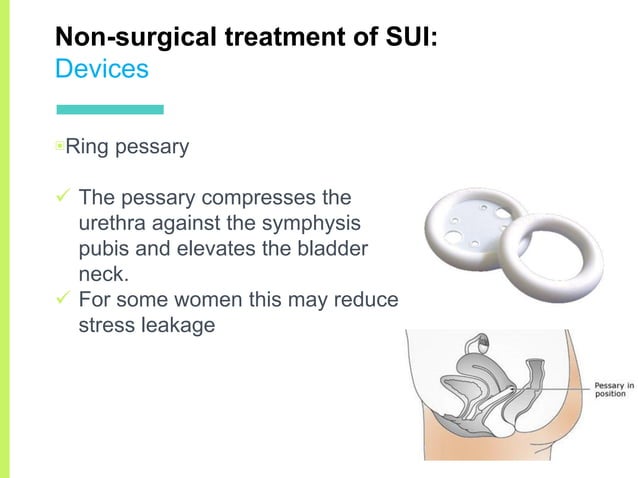Stress urinary incontinence | PDF