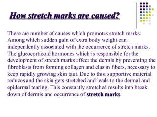 Stretch Marks Treatments | PPT