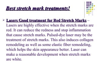 Stretch Marks Treatments | PPT