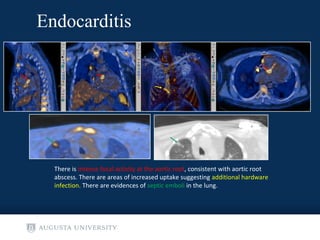 Non-malignant cardiac findings on FDG PET CT | PPT