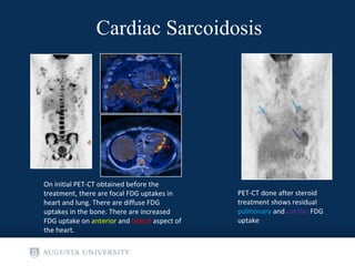 Non-malignant cardiac findings on FDG PET CT | PPT