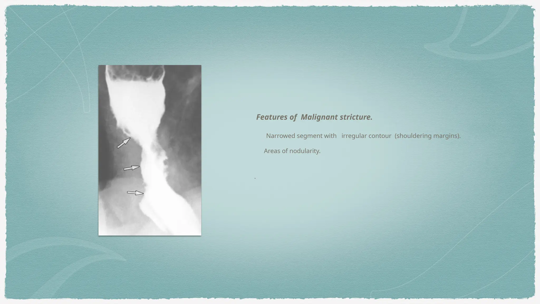 Radiographic imaging of esophageal strictures.pptx