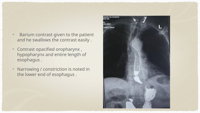 Radiographic imaging of esophageal strictures.pptx
